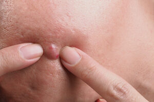 Abscess Incision and Drainage Treatment in Houston, TX | Luxe Primary ...